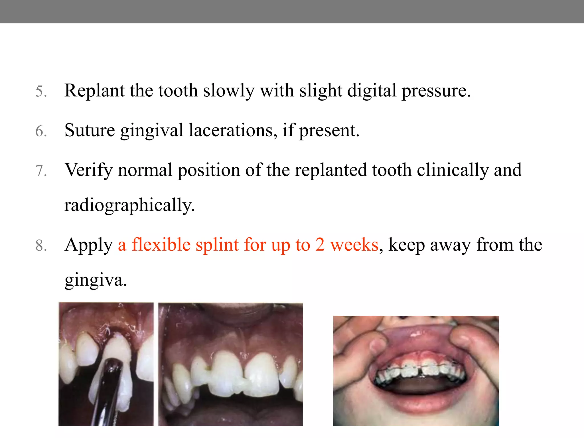 Guidelines for the management of avulsion | PPTX