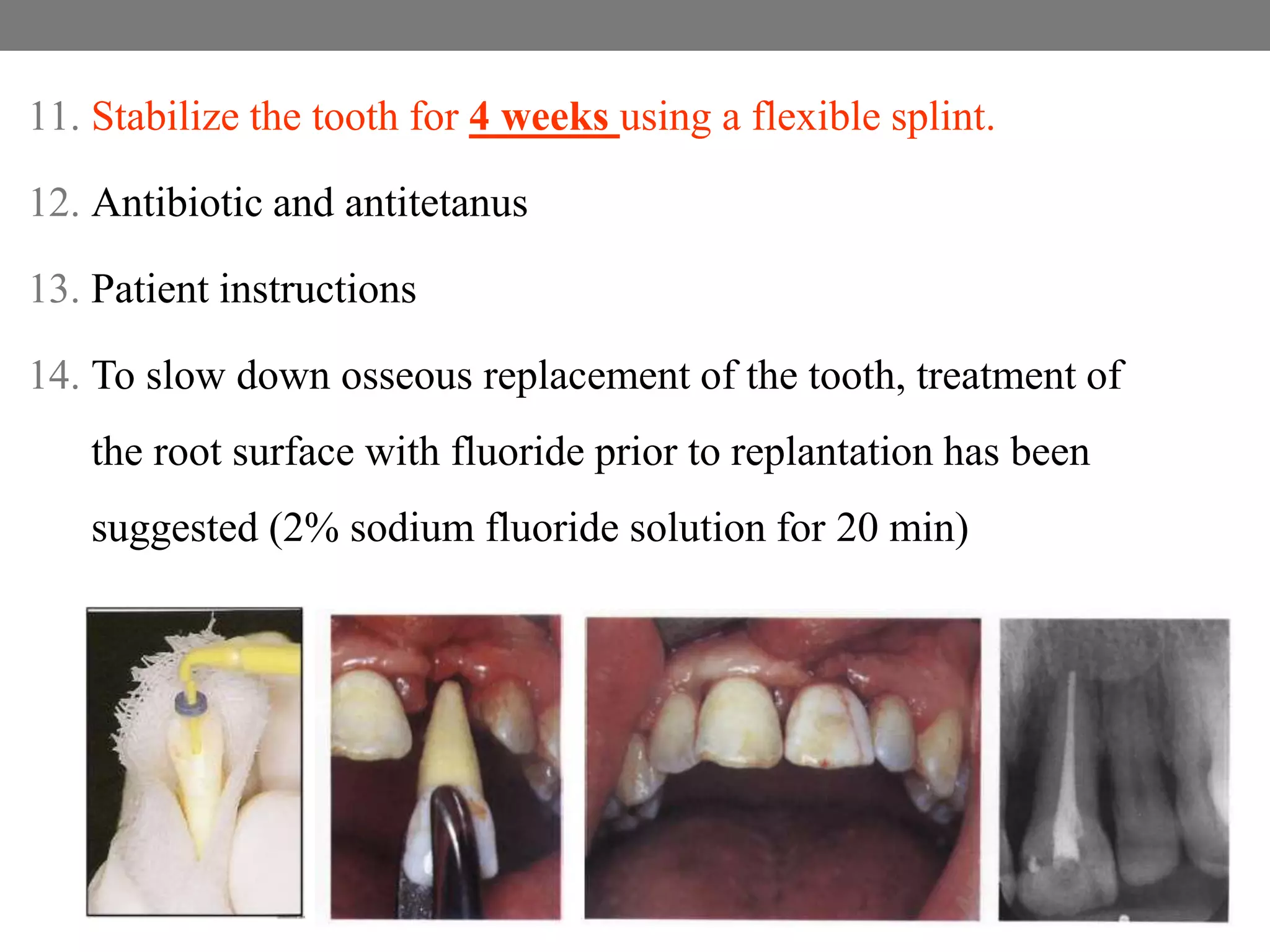 Guidelines for the management of avulsion | PPTX | Dental Health ...