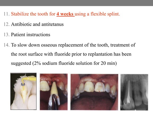 Guidelines for the management of avulsion | PPTX | Dental Health ...