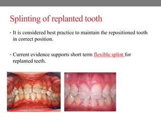 Guidelines for the management of avulsion | PPTX