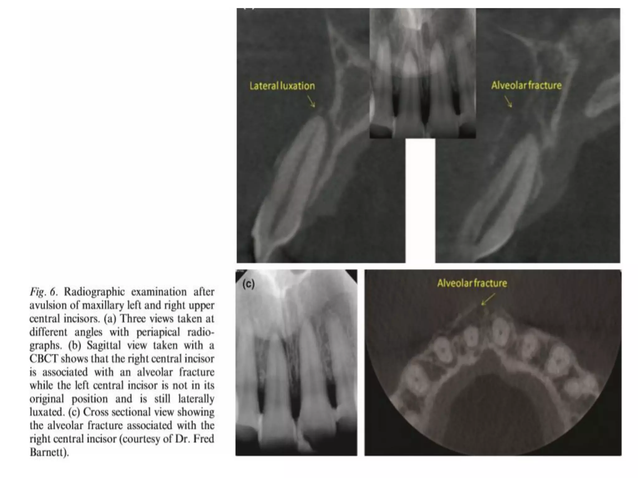 Guidelines for the management of traumatic dental injuries.ii.avulsion ...
