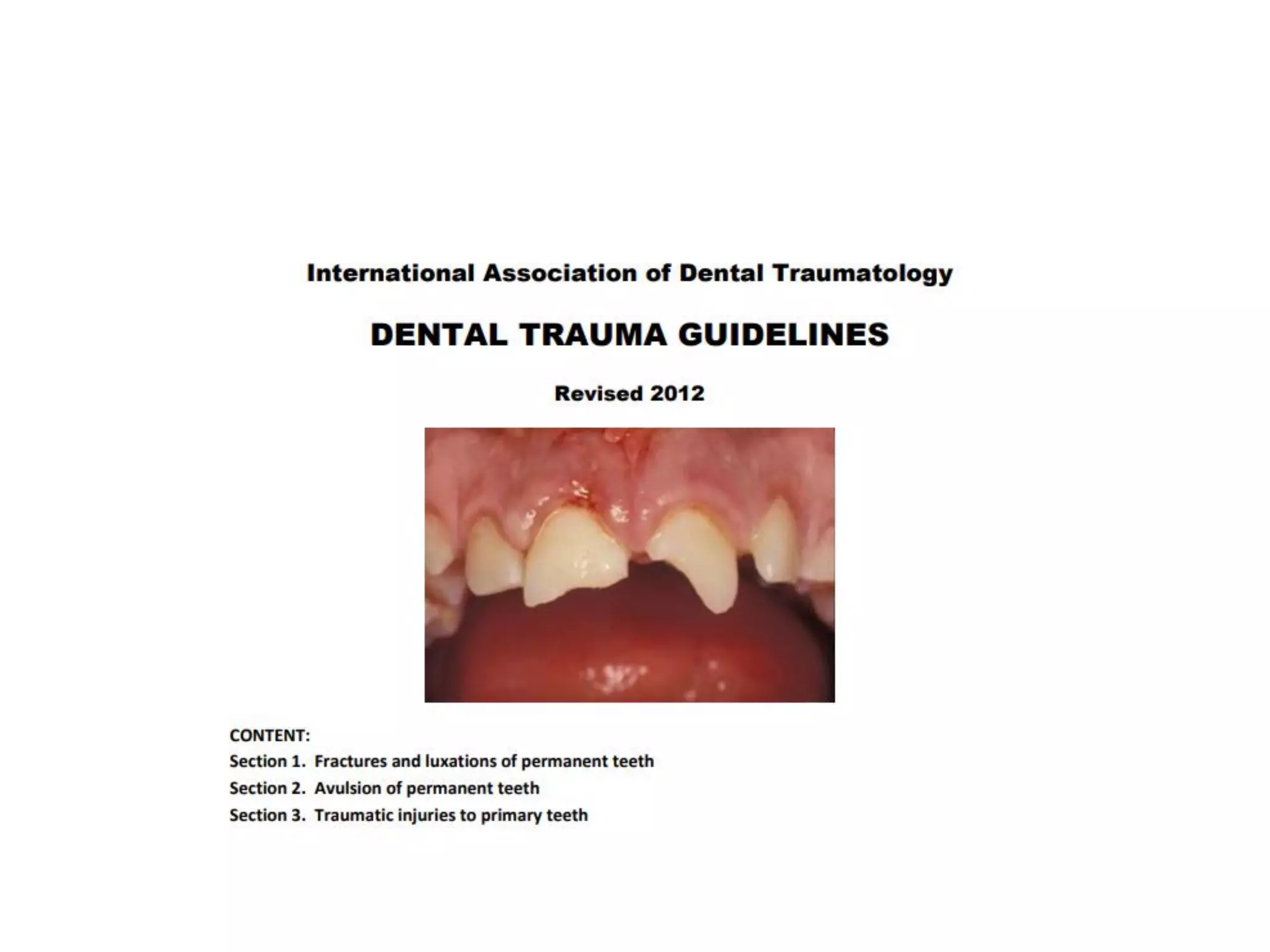 Guidelines for the management of traumatic dental injuries.ii.avulsion ...
