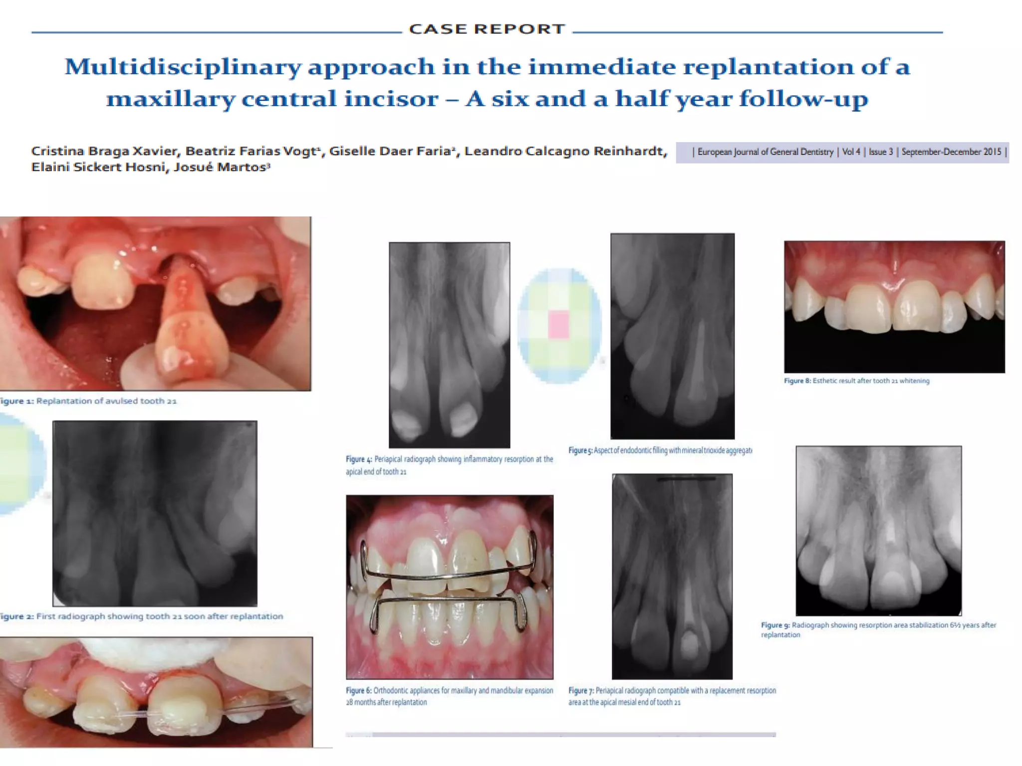 Guidelines for the management of traumatic dental injuries.ii.avulsion ...