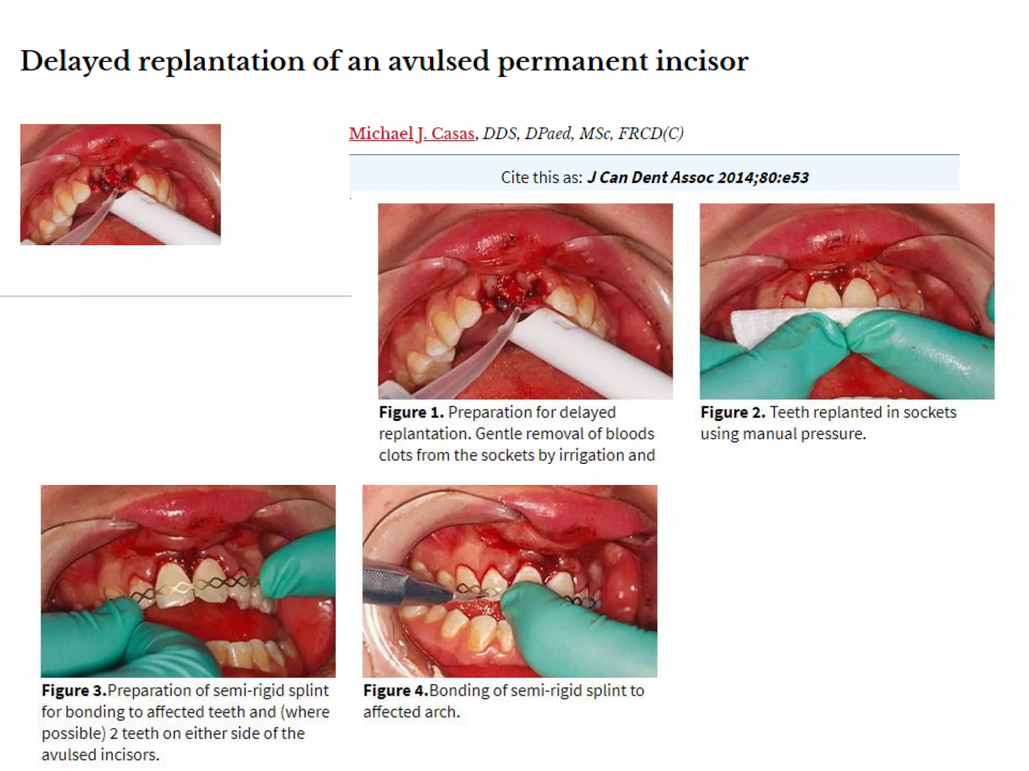 Guidelines for the management of traumatic dental injuries.ii.avulsion ...