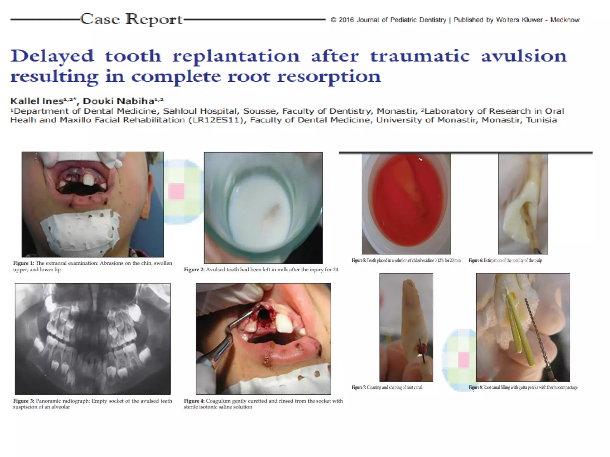 Guidelines for the management of traumatic dental injuries.ii.avulsion ...