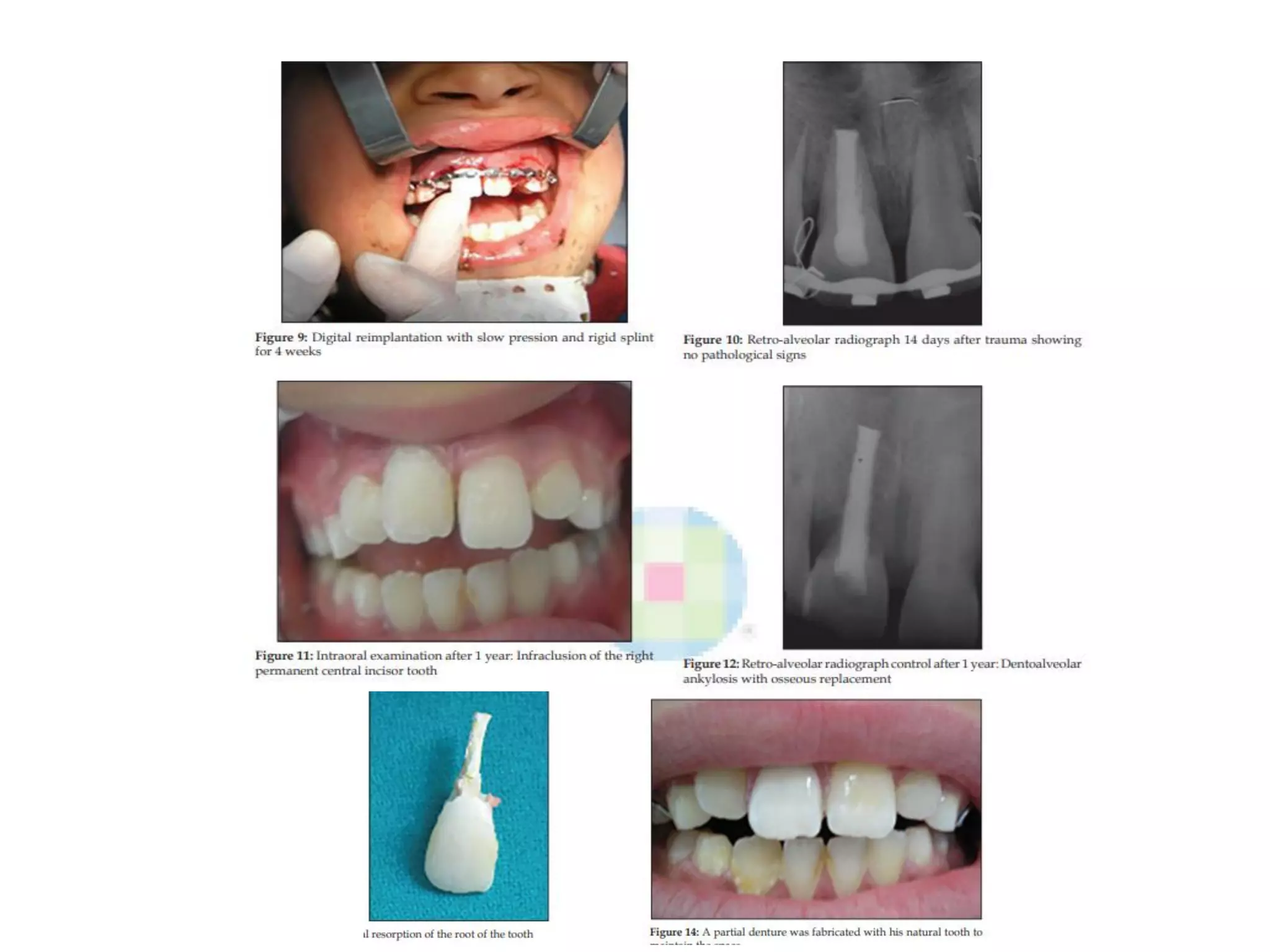Guidelines for the management of traumatic dental injuries.ii.avulsion ...