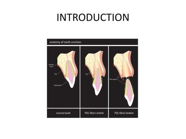 Guidelines for the management of traumatic dental injuries.ii.avulsion ...