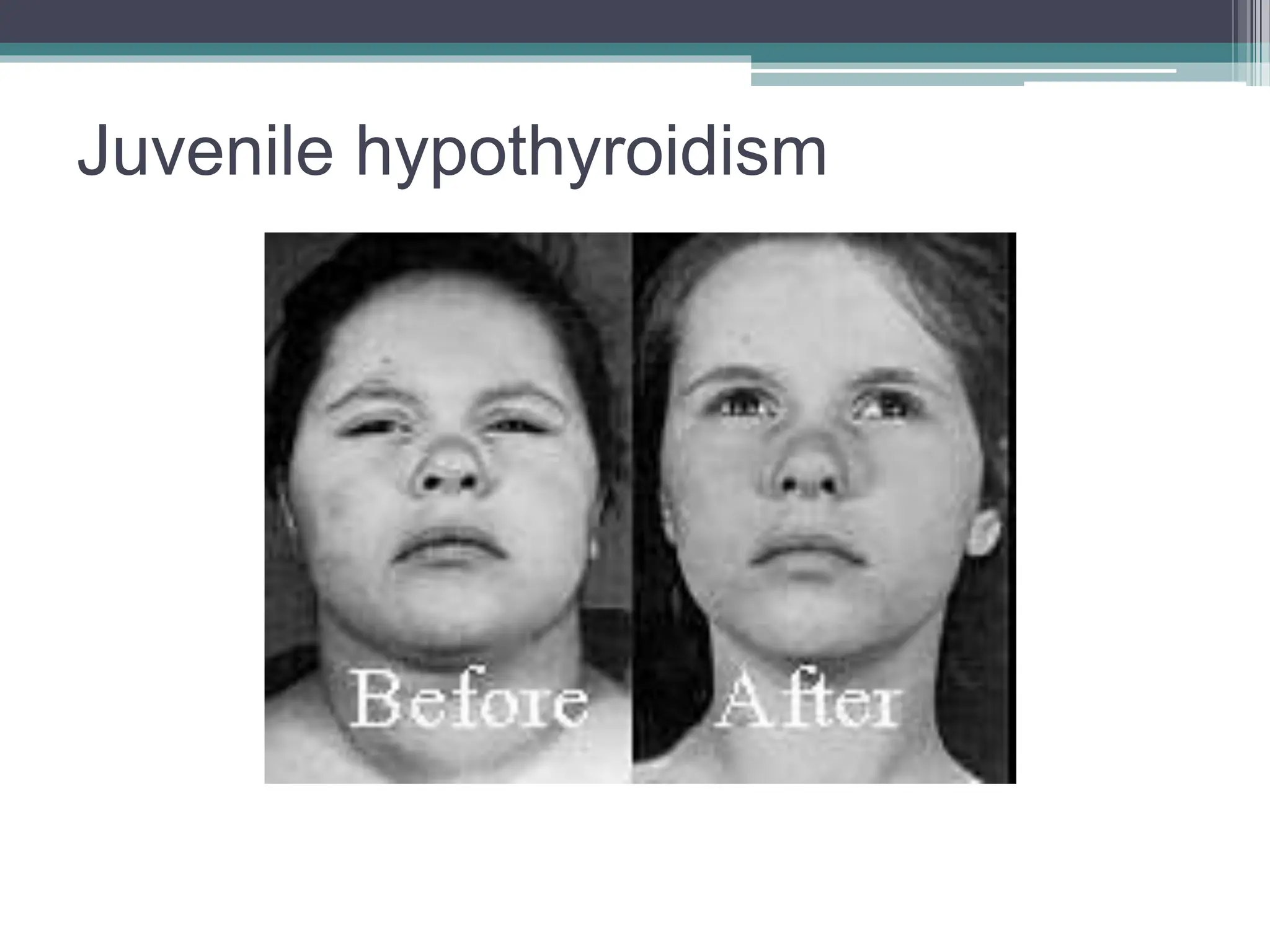 Guidelines for the Treatment of Hypothyroidism.pptx