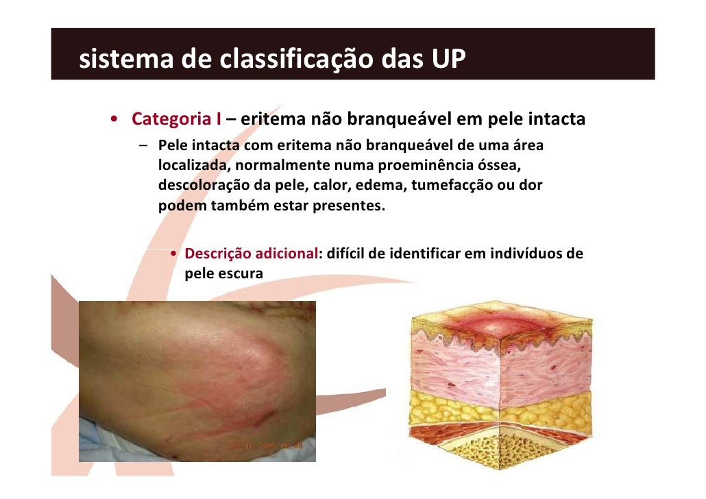 Guidelines Prevenção úlceras de pressão