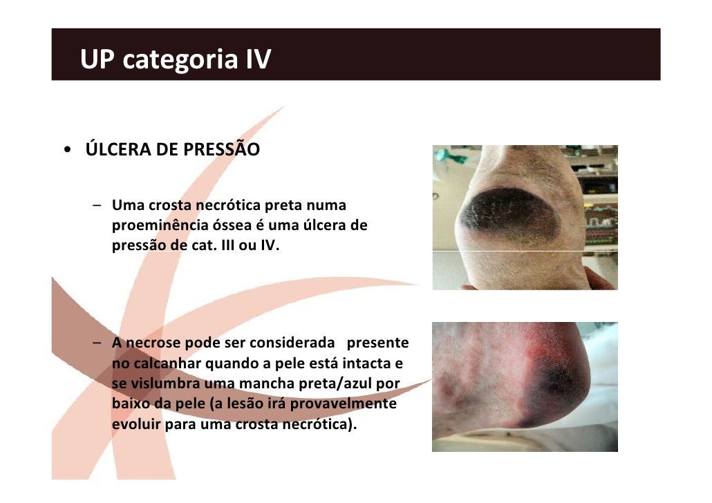 Guidelines Prevenção úlceras de pressão