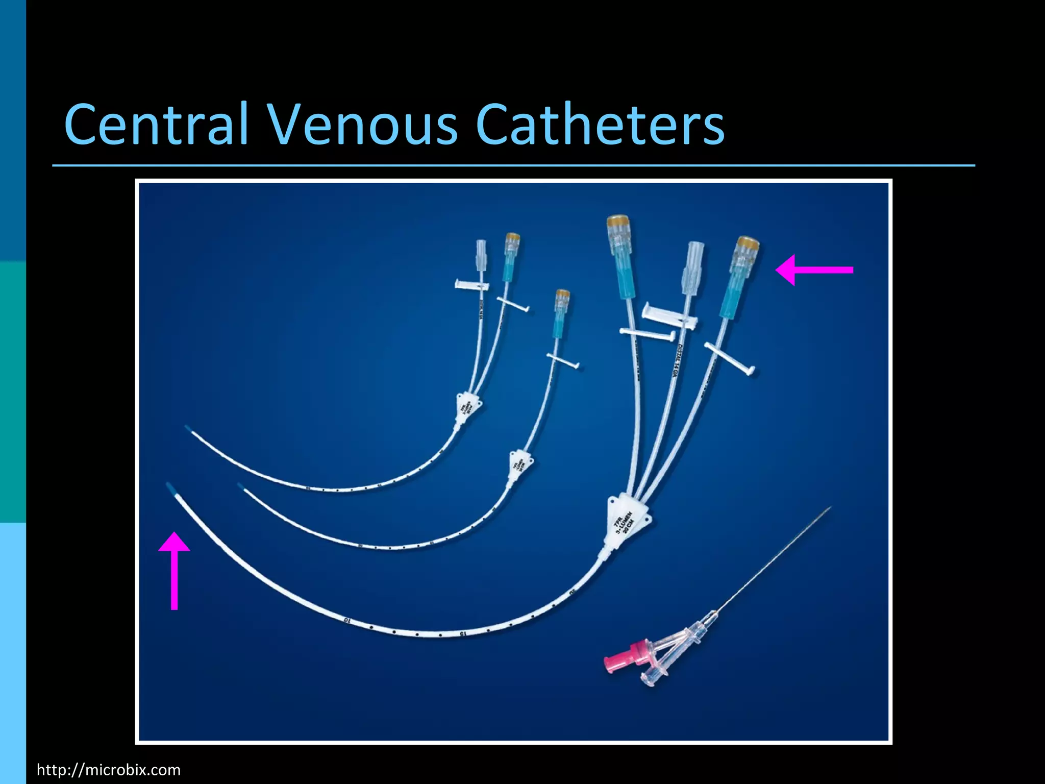 Guideline Update For The Management Of Intravenous Catheter Related ...