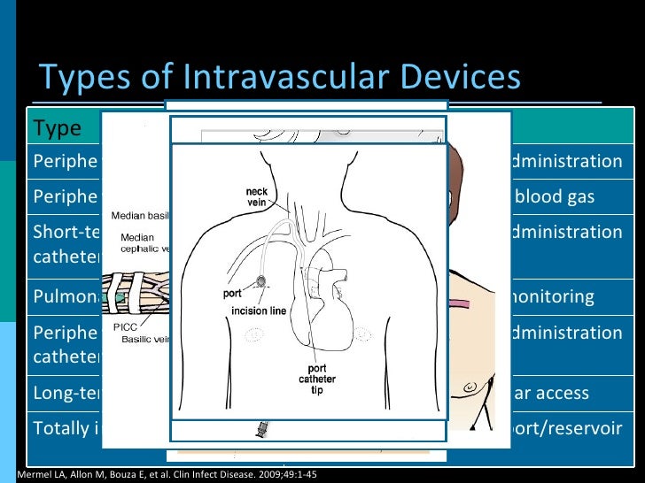 Guideline Update For The Management Of Intravenous Catheter Related I…
