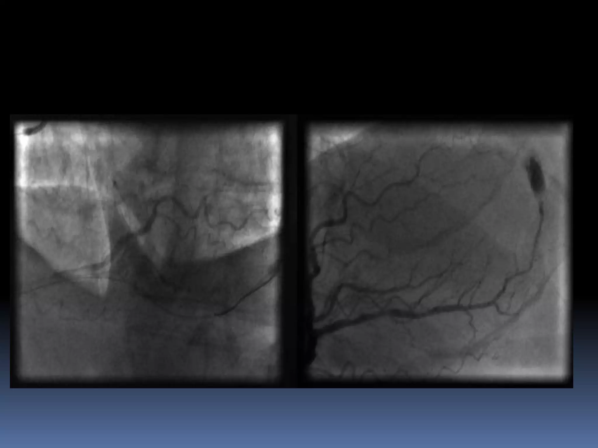 Choice And Use Of Appropriate Guidewire in PCI | PPTX