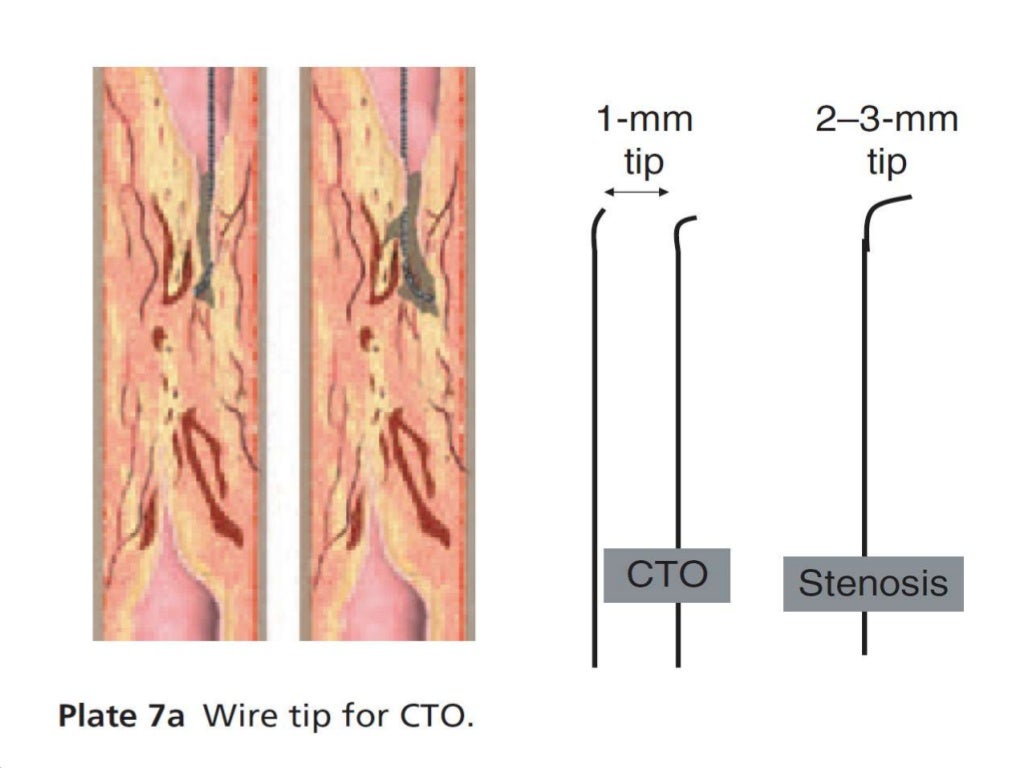 Choice And Use Of Appropriate Guidewire in PCI