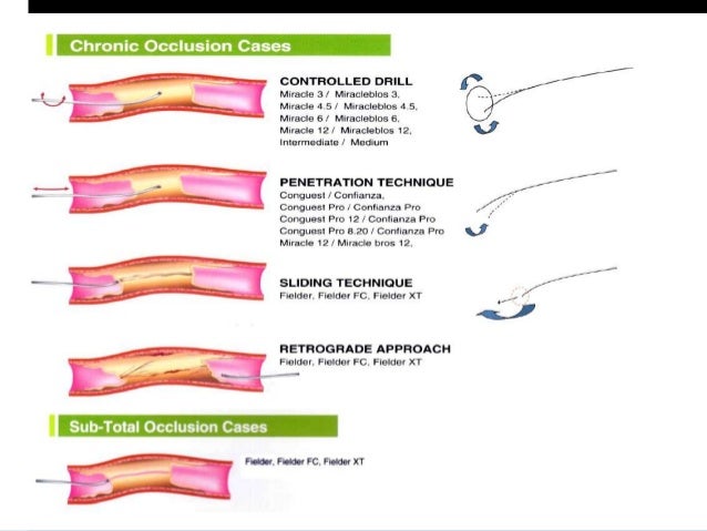 Choice And Use Of Appropriate Guidewire In PCI