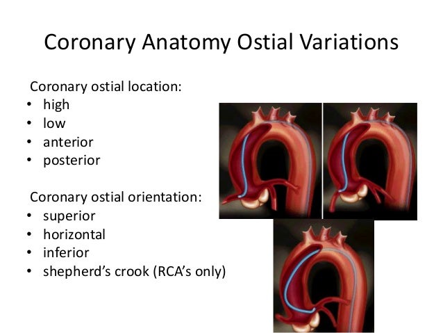 Guiding catheter in coronary intervention