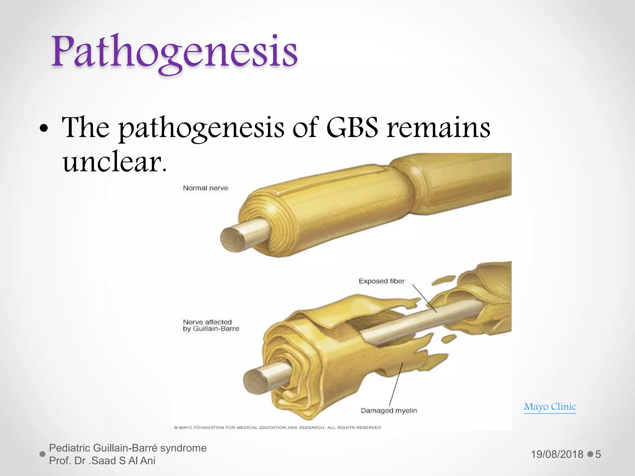 Guillain - Barré syndrome | PPTX