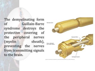 guillainbarresyndrome-2007291037110.pptx