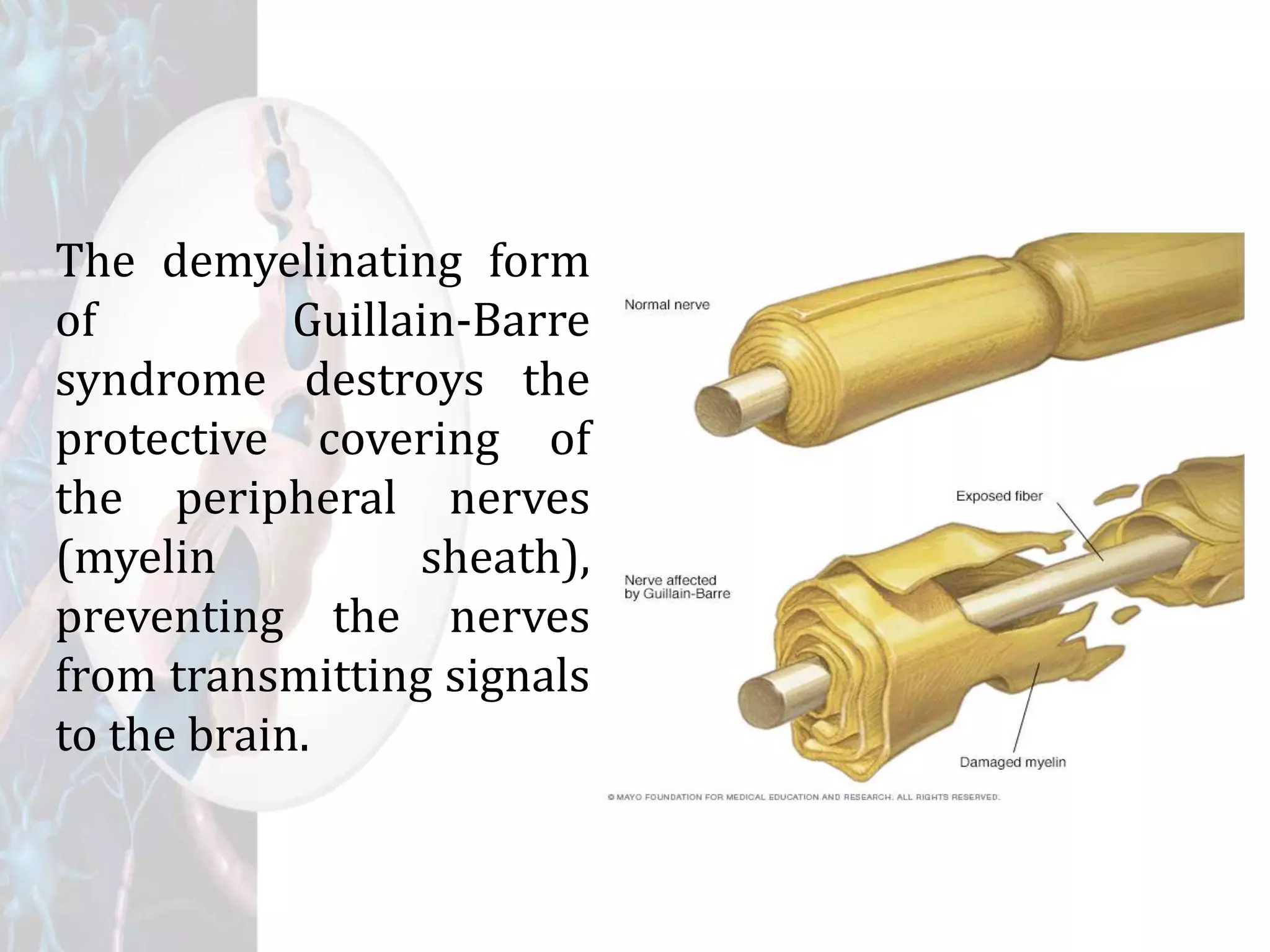 Guillain Barre Syndrome | PPTX