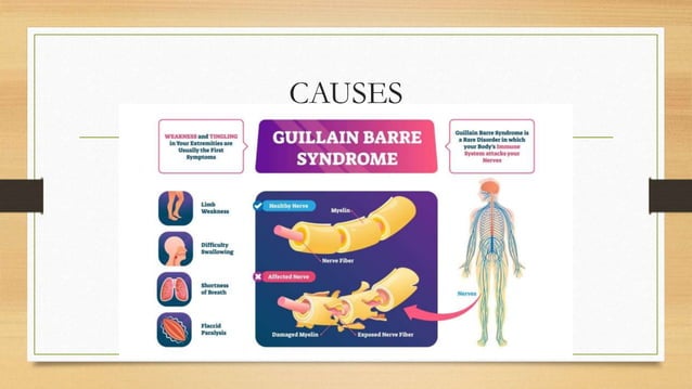 Guillain barre syndrome | PPT