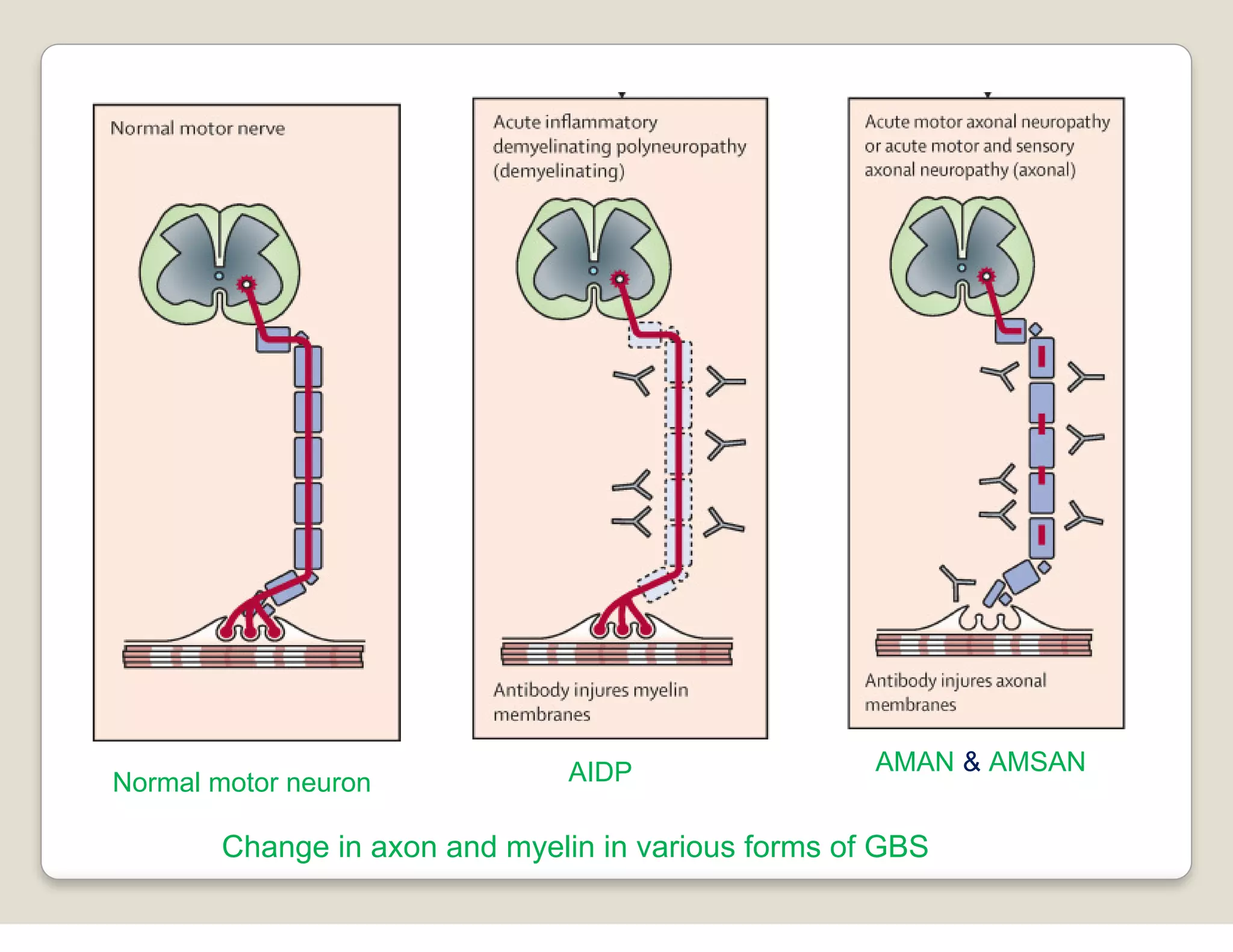 Guillain Barre syndrome (GBS) .pdf