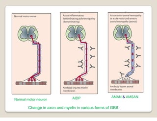 Guillain Barre syndrome (GBS) .pdf