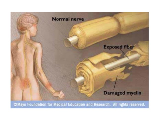 Guillain Barre Syndrome and Myasthenia Gravis.pdf