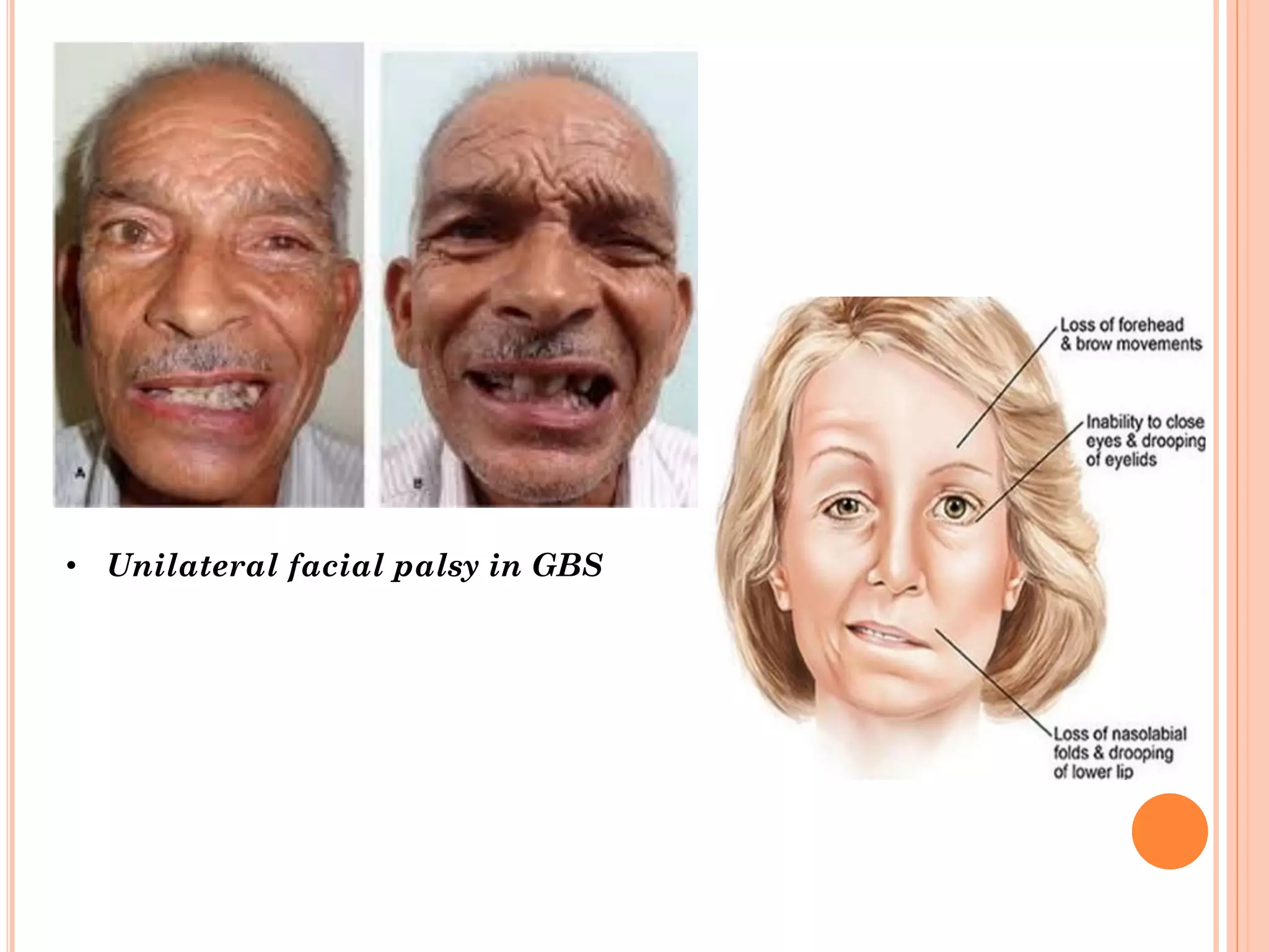 Guillain Barre Syndrome (GBS) | PDF