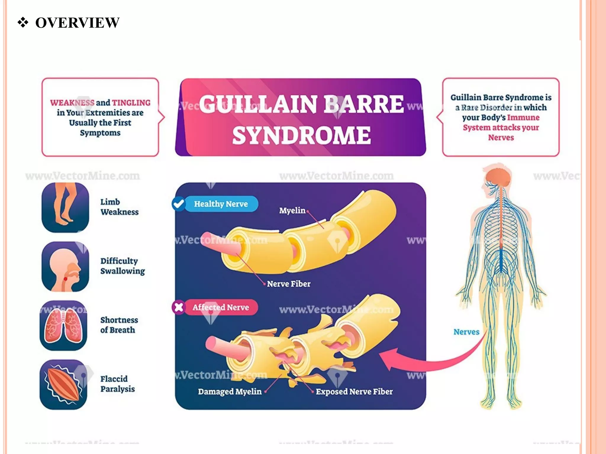 Guillain Barre Syndrome (GBS) | PDF