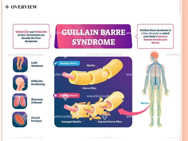 Guillain Barre Syndrome (GBS) | PDF | Brain and Nervous System ...