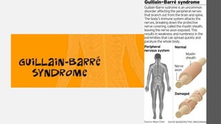 Guillain_Barre_Syndrome_GBS_Tipe_AMSAN.pptx