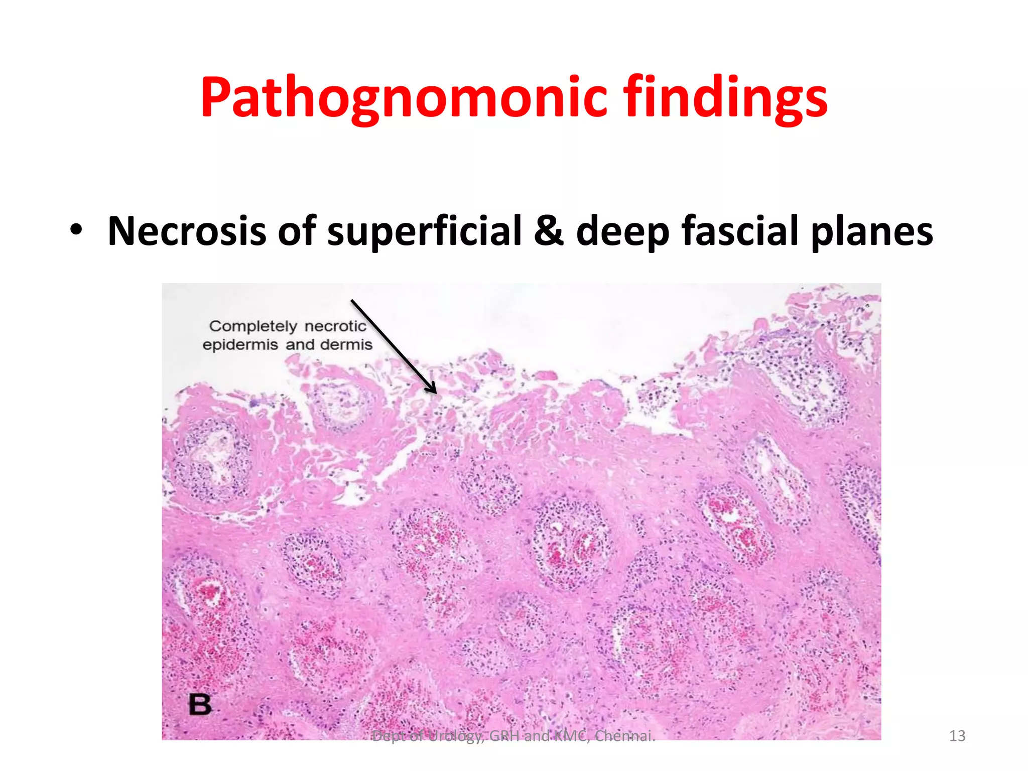 Fournier gangrene | PDF