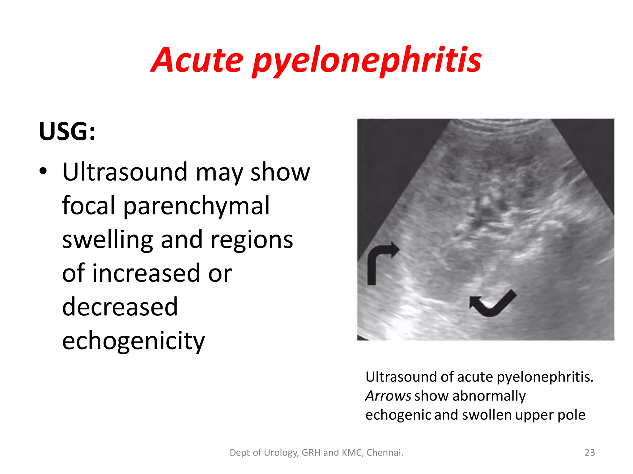 UPPER URINARY TRACT INFECTION | PDF
