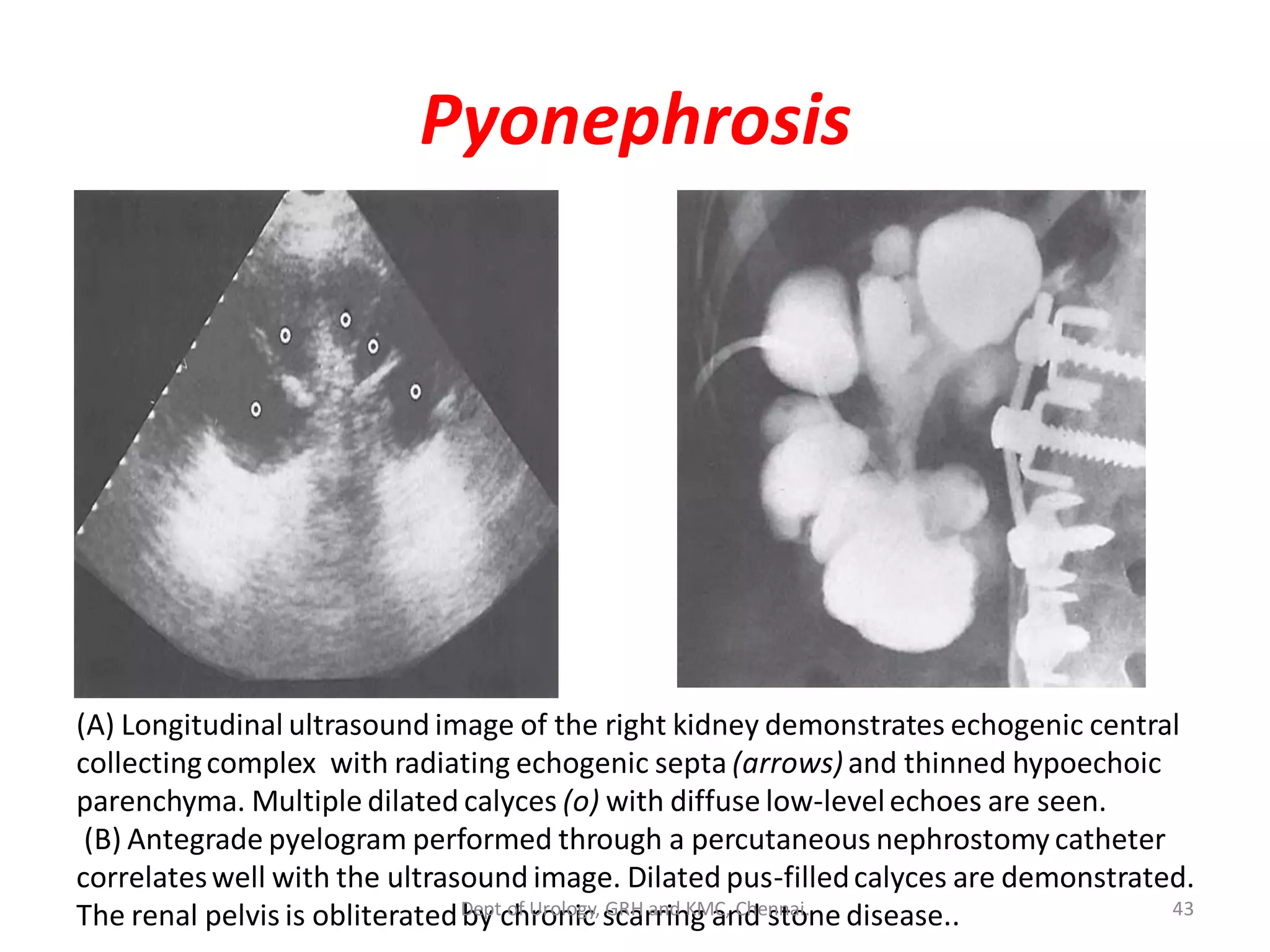 UPPER URINARY TRACT INFECTION | PDF