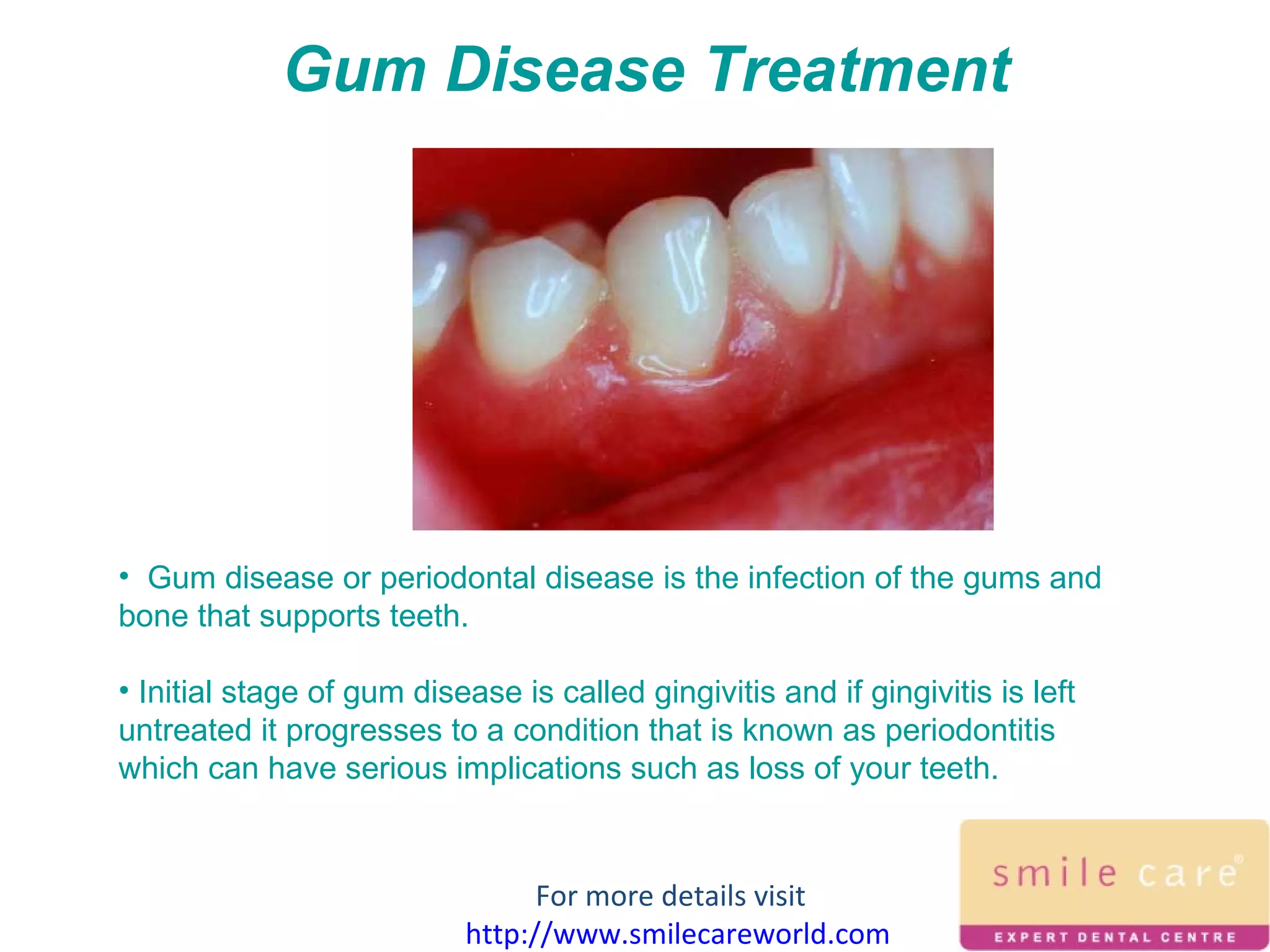 Gum disease treatment | PPT