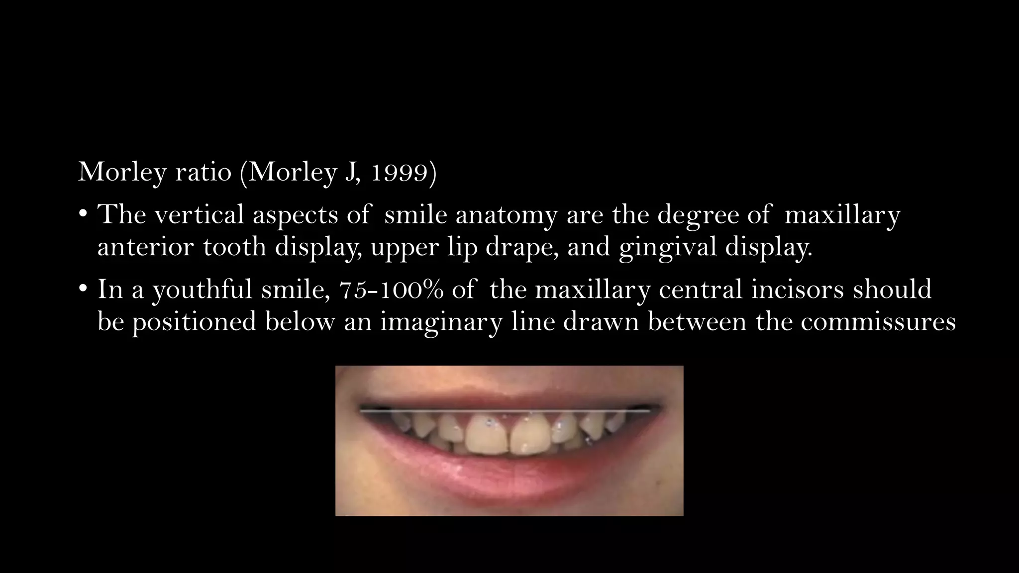 Management of Gummy smile | PDF