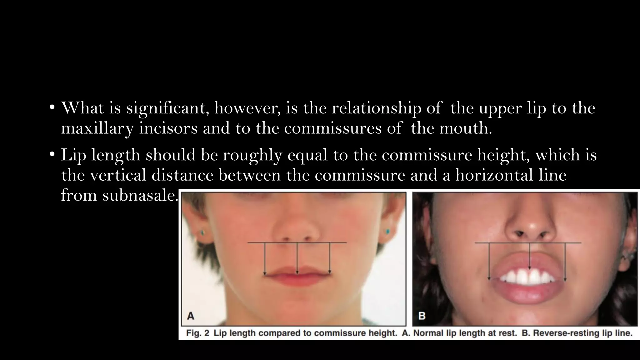 Management of Gummy smile | PDF
