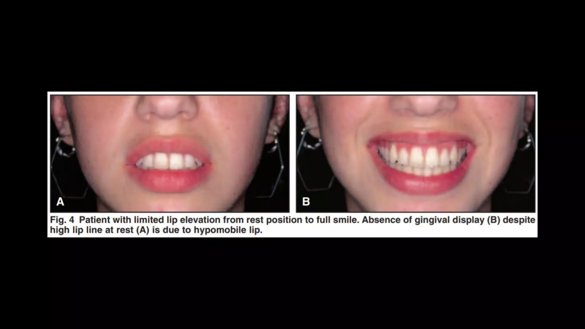Management of Gummy smile | PDF