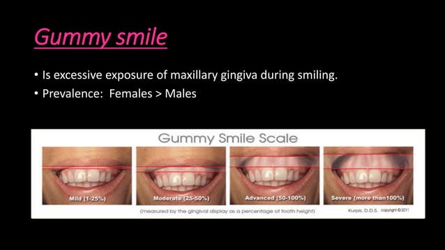 gummy smile.pptx | Dental Health | Diseases and Conditions