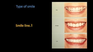Gummy Smile causes types clasfications treatment options.pptx