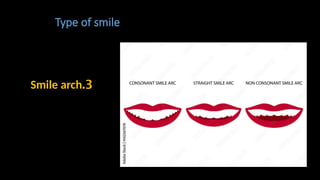 Gummy Smile causes types clasfications treatment options.pptx