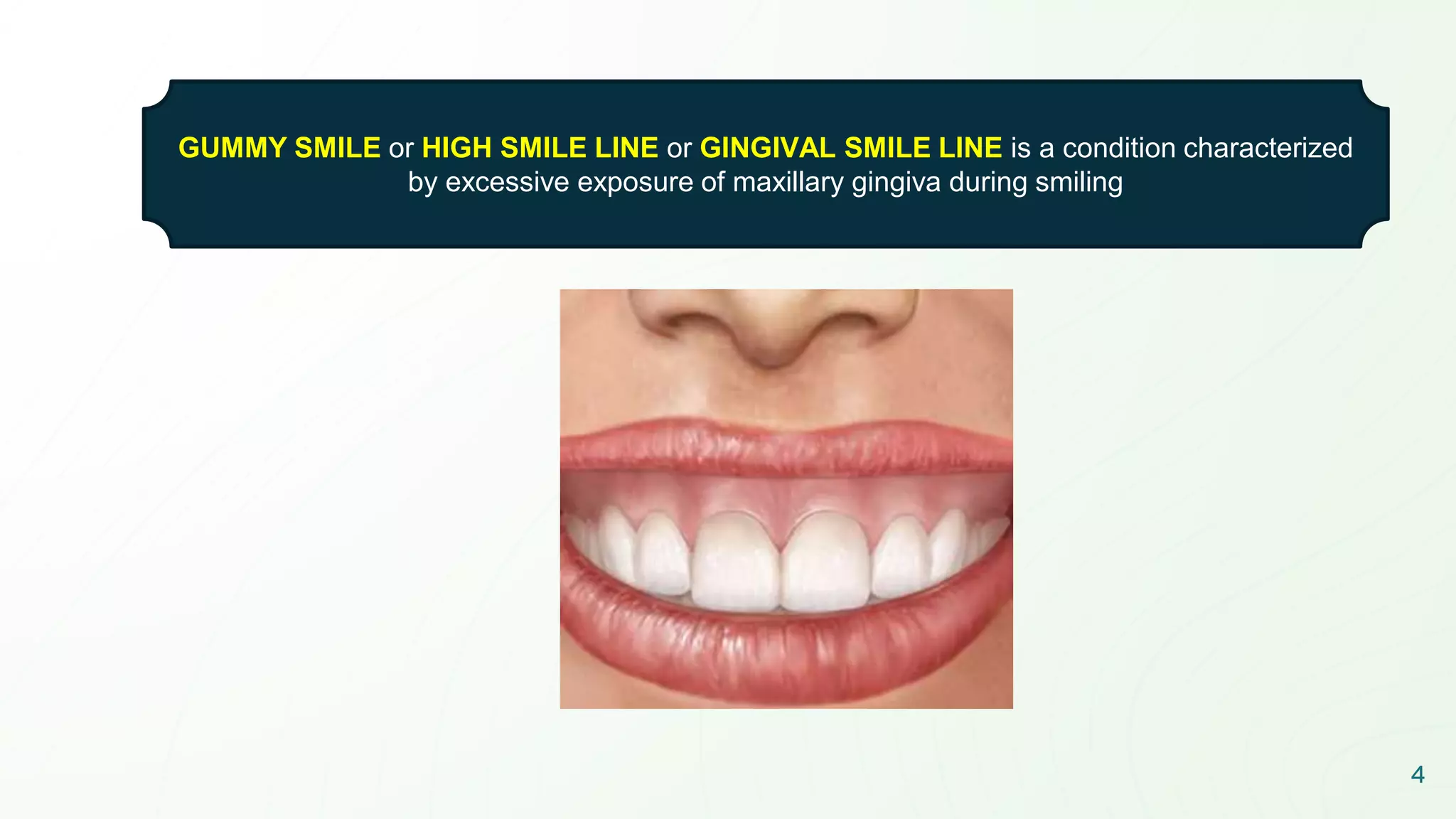 Gummy smile ppt | PPTX