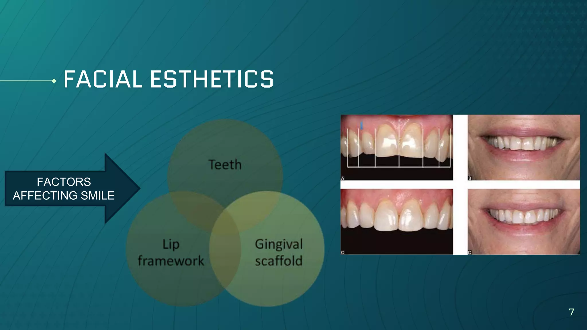 Gummy smile ppt | PPTX