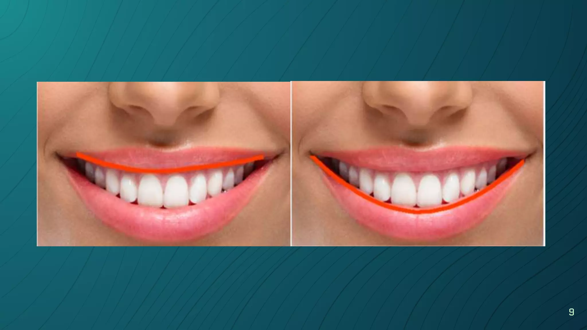 Gummy smile ppt | PPTX