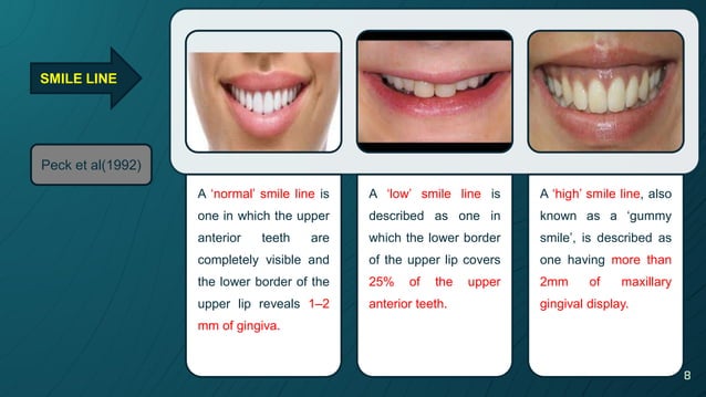 Gummy smile ppt | PPTX | Oral care | Personal Care