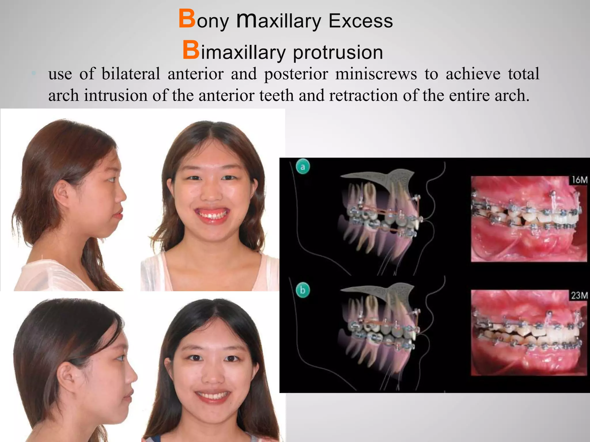 Gummy Smile with Evidence in Orthodontics.pptx