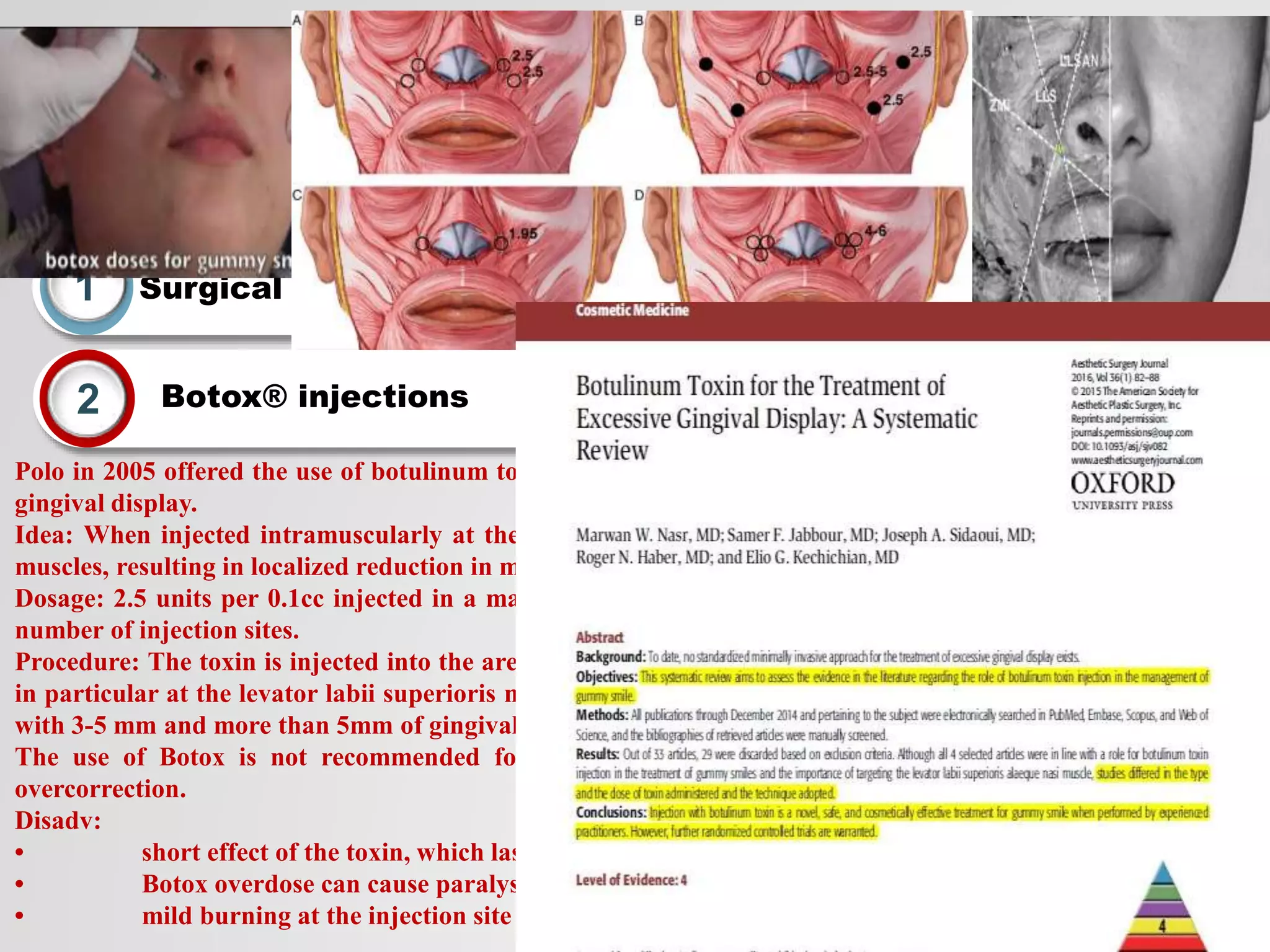Gummy Smile with Evidence in Orthodontics.pptx