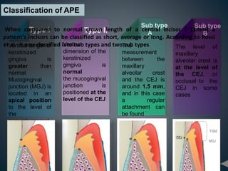 Gummy Smile with Evidence in Orthodontics.pptx