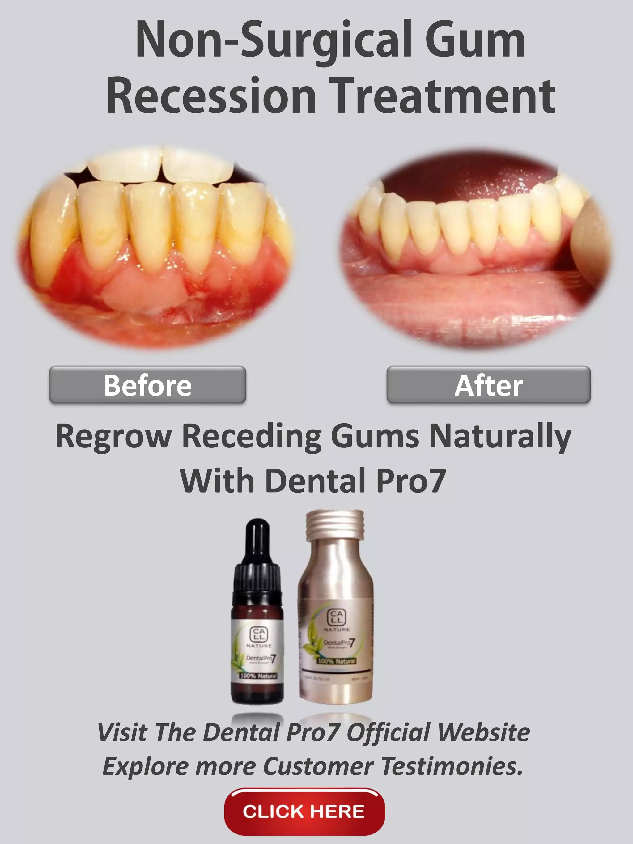 Gum Recession Treatment without Surgery | PDF