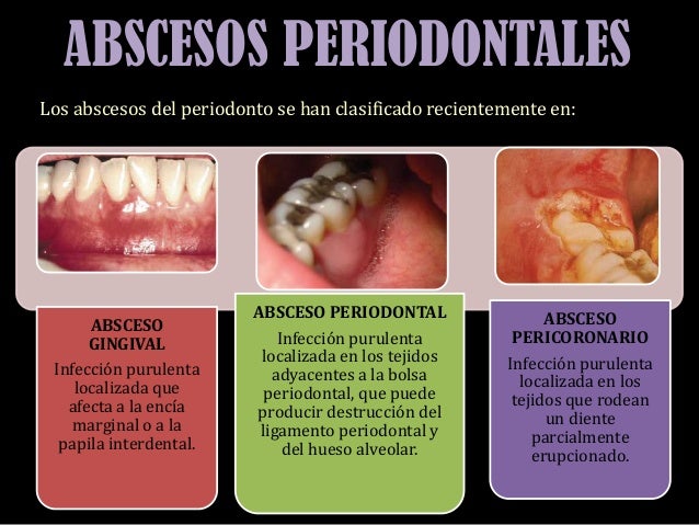 Absceso Periodontal: Síntomas, Tratamiento Y Prevención – AXLIO